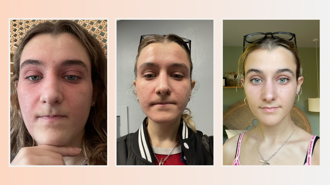 Embracing My Skin Journey: Overcoming Eczema and Topical Steroid Withd ...